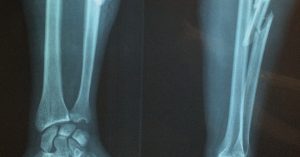 What is the difference between a fracture and a break? — Access Ortho