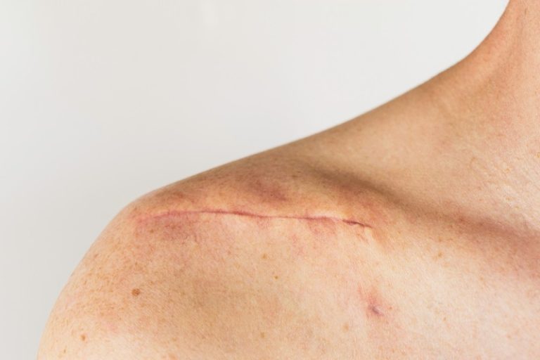 Understanding Clavicle Injuries — Access Ortho