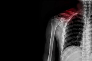 Understanding Clavicle Injuries — Access Ortho