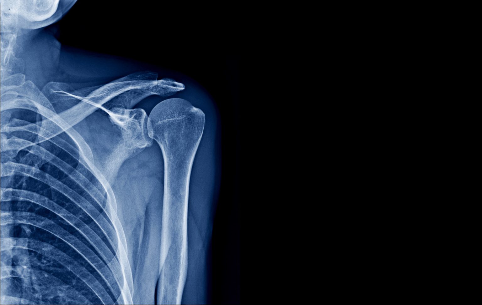 Understanding Shoulder Fractures: Causes, Diagnosis, and Treatment ...