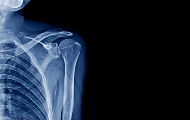 Understanding Shoulder Fractures: Causes, Diagnosis, and Treatment ...