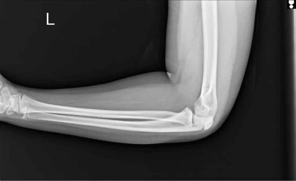 Radial Head Fracture: Understanding, Treatment, and Recovery — Access Ortho