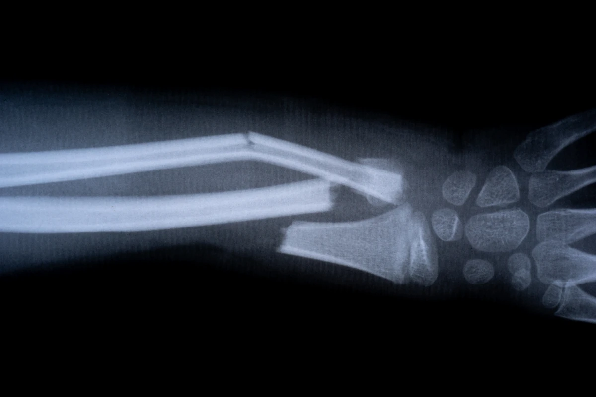 Uneven Arm Bone Fracture