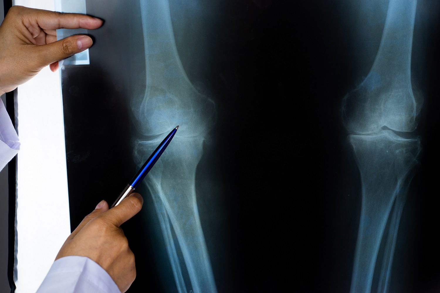 Why is it Important to Get Accurate Early Diagnosis in Musculoskeletal ...