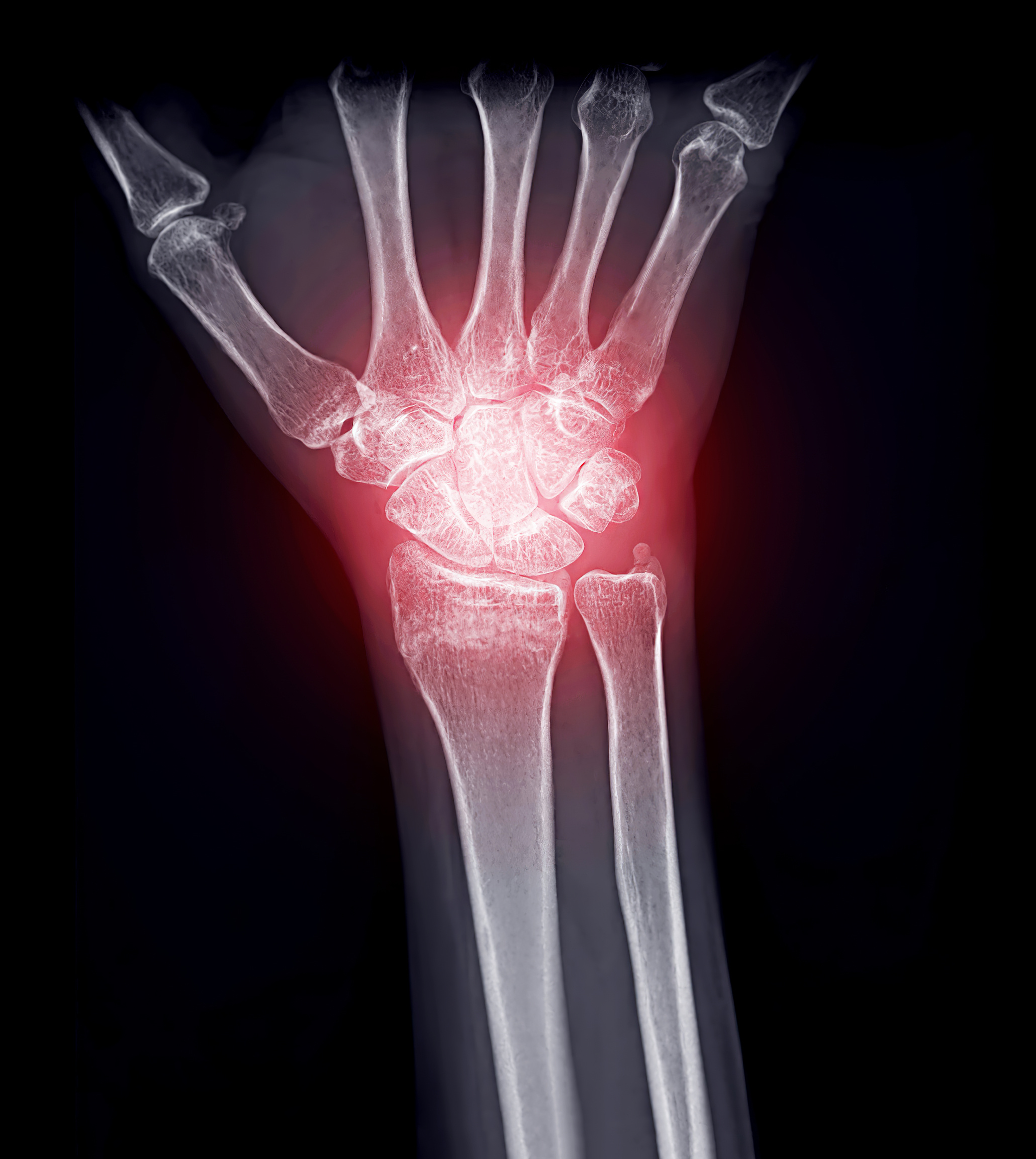Carpal Bone Fractures/Breaks — Access Ortho