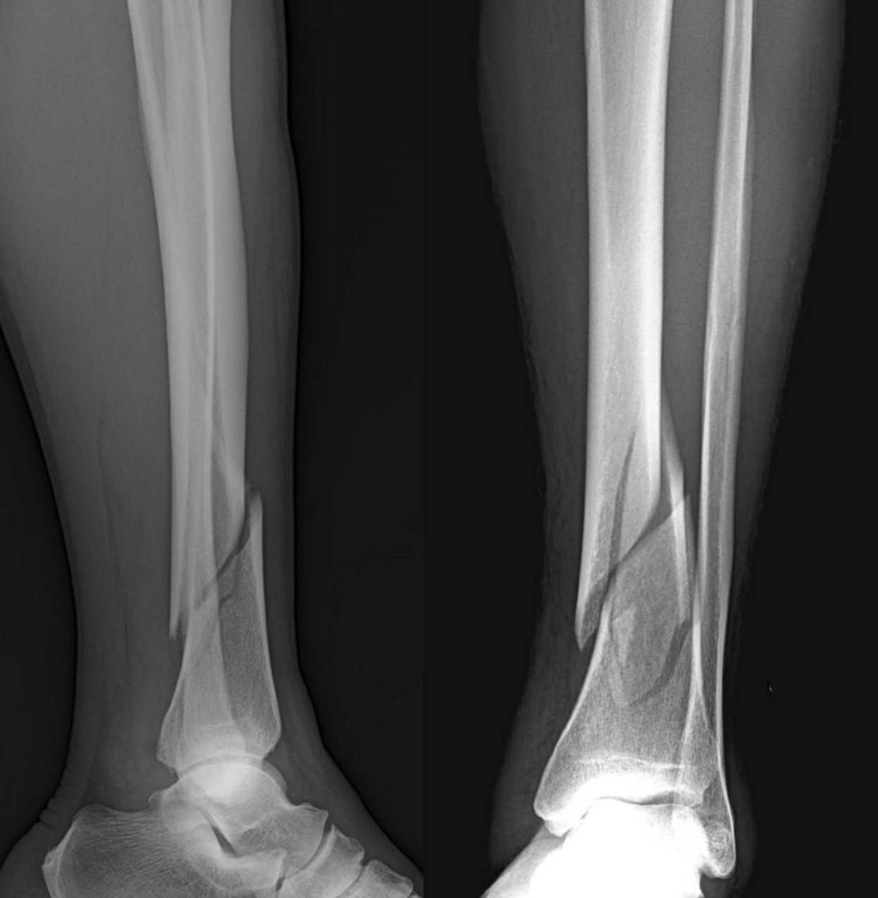 Leg Fractures: Broken/Fractured Leg — Access Ortho