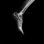 Distal Tibia Fractures — Access Ortho