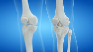 Fibular Fracture — Access Ortho