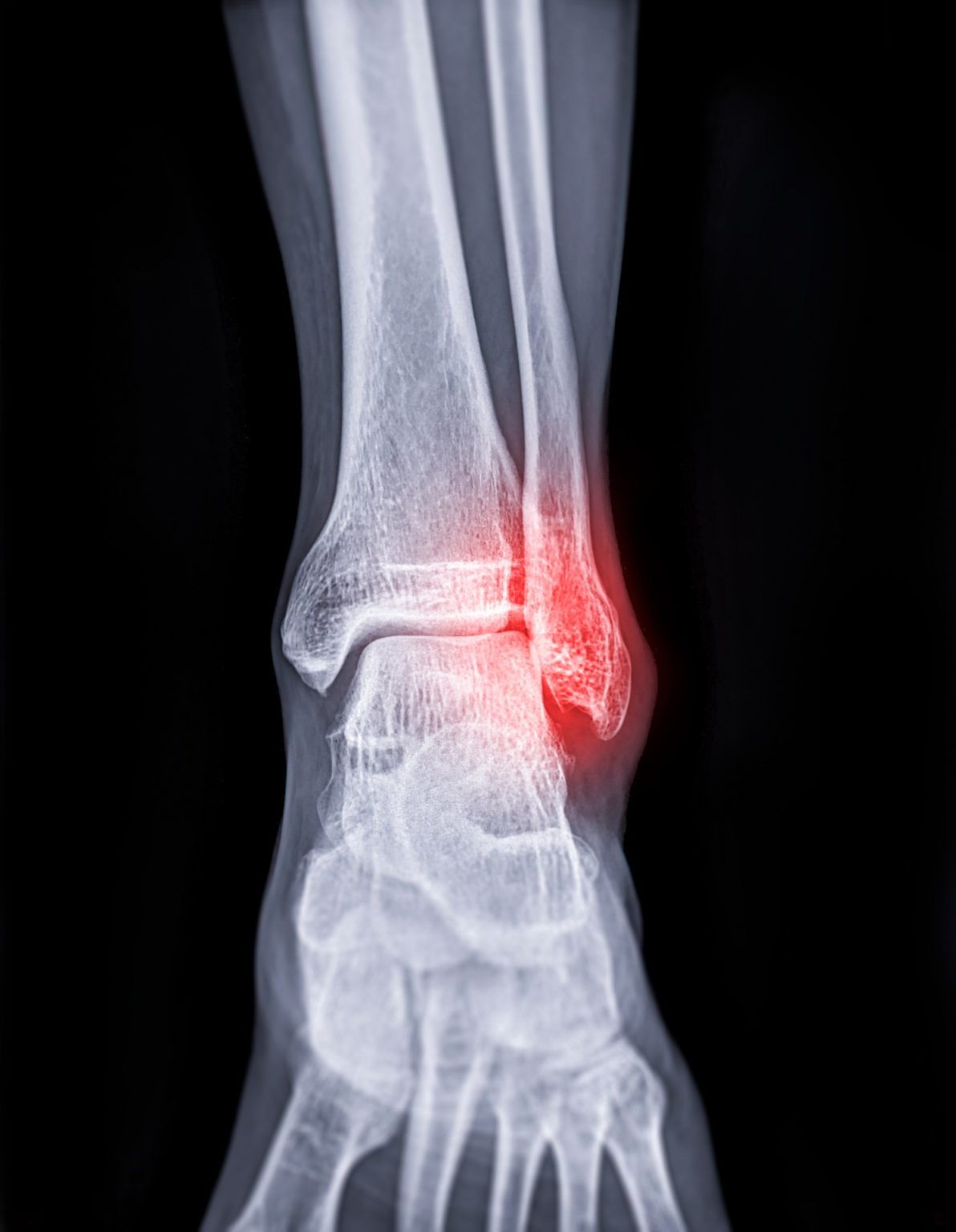 Ankle Fracture — Access Ortho