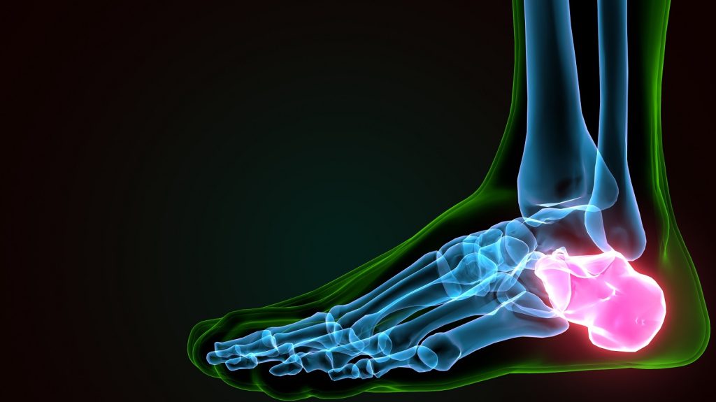 Calcaneus Heel Bone Fracture — Access Ortho