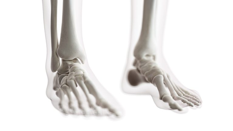 Navicular Fracture — Access Ortho