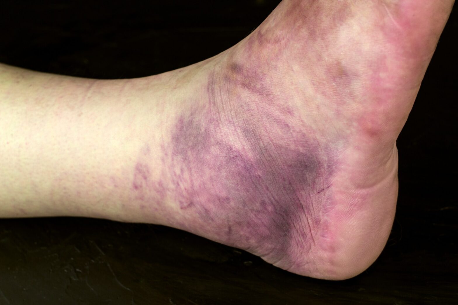 Ankle Ligament Injuries — Access Ortho